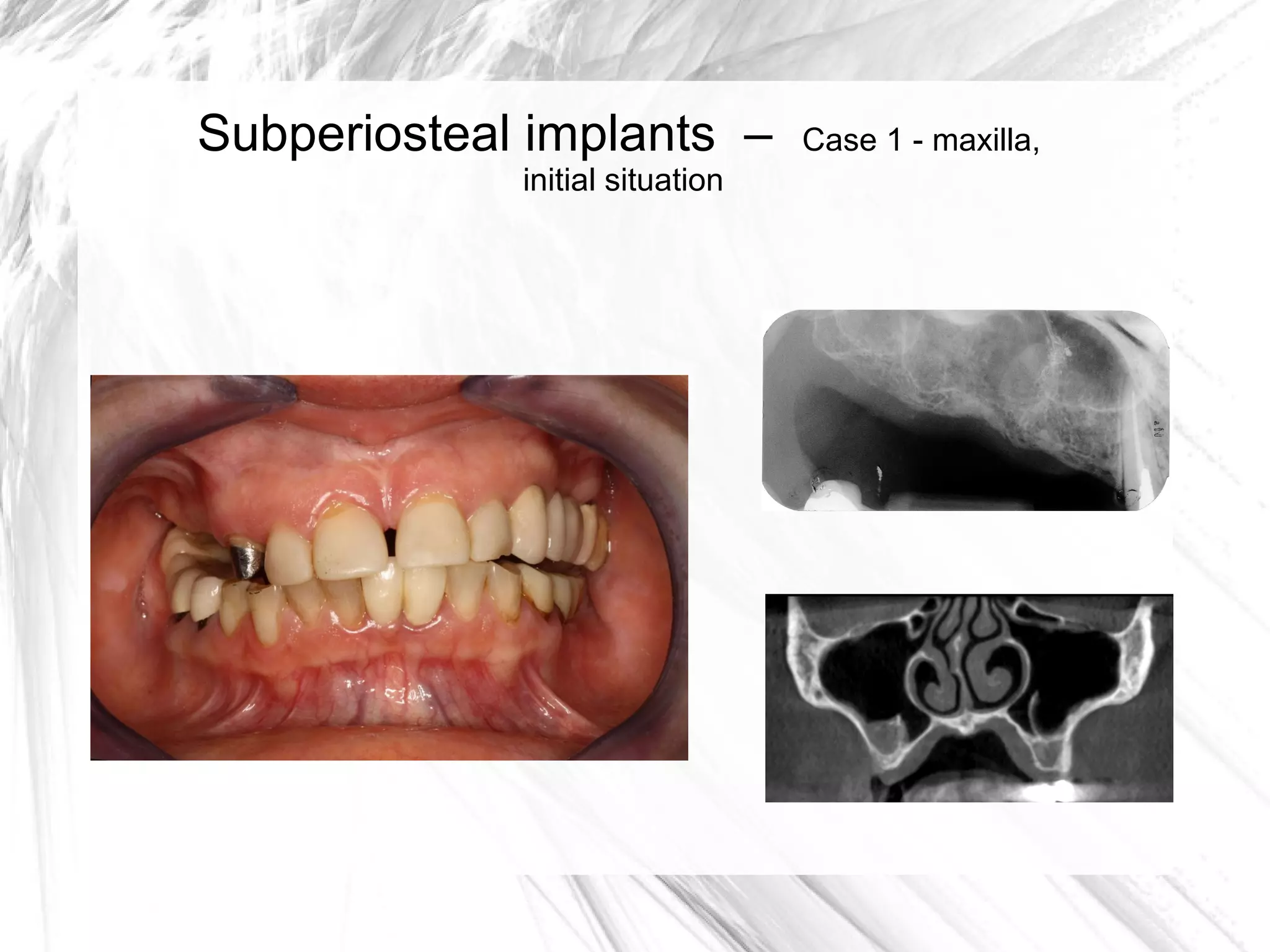 Introduction to subperiosteal implants | ODP