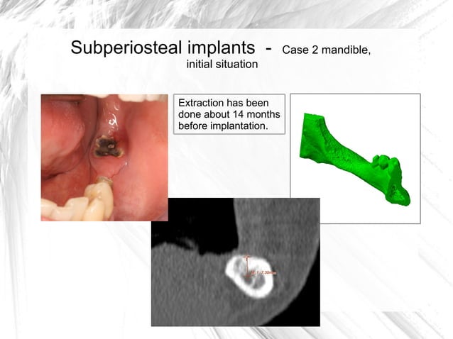 Introduction to subperiosteal implants | ODP | Bone and Joint ...