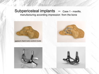 Introduction to subperiosteal implants | ODP