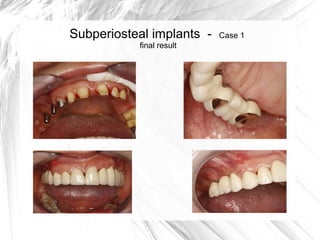 Introduction to subperiosteal implants | ODP