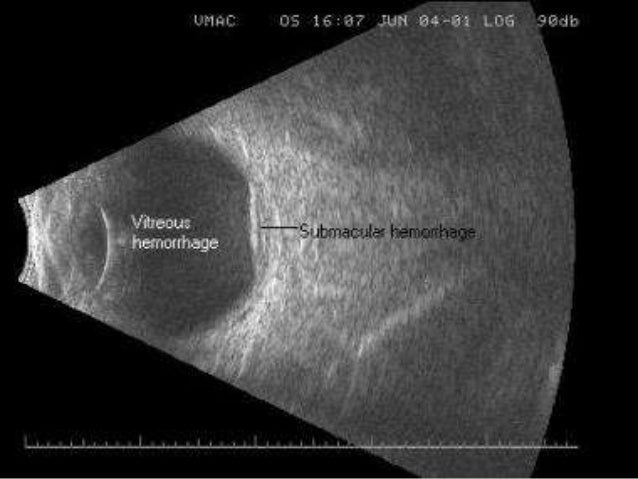 Subretinal hemorrhage
