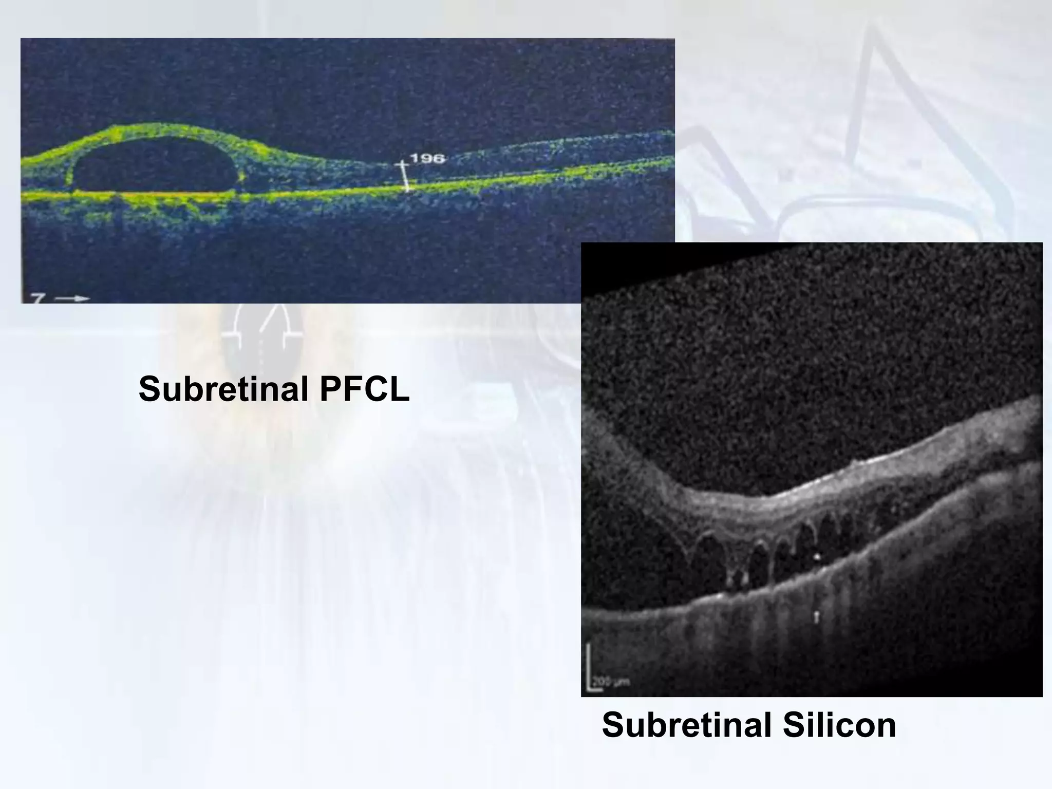 Subretinal perfluorocarbon liquid case report | PPT | Free Download