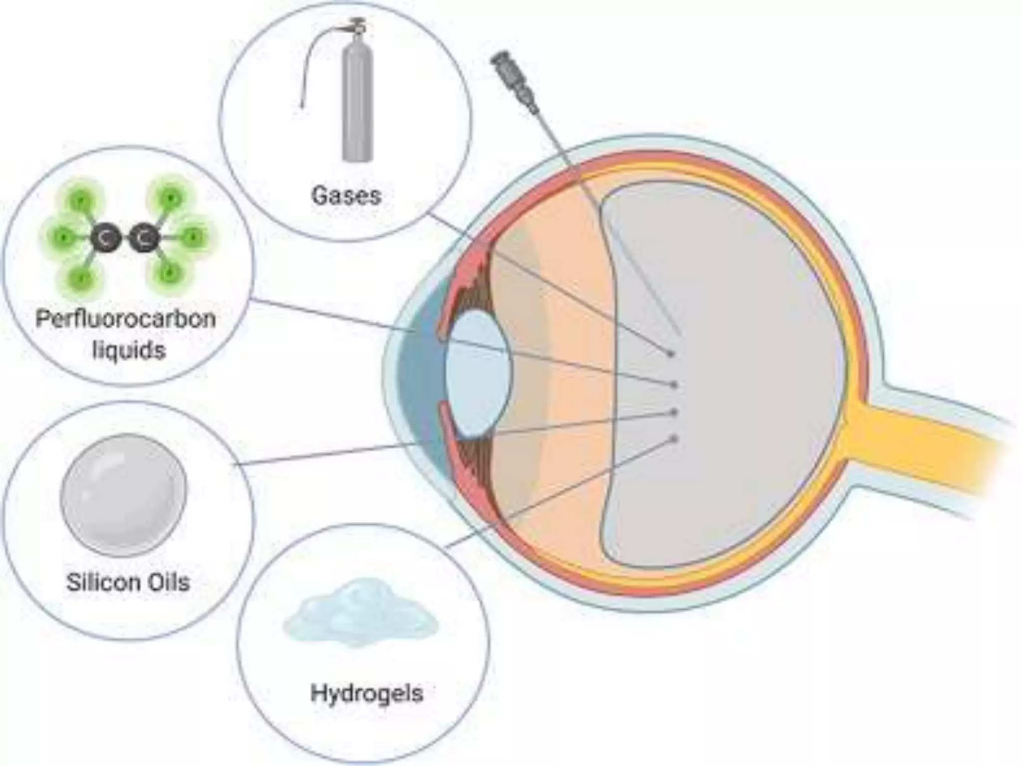 Subretinal perfluorocarbon liquid case report | PPT