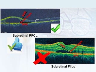 Subretinal perfluorocarbon liquid case report | PPT