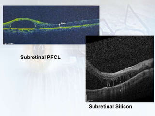 Subretinal perfluorocarbon liquid case report | PPTX