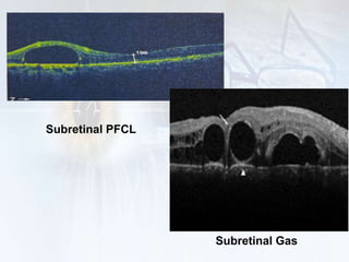 Subretinal perfluorocarbon liquid case report | PPTX