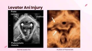 Basics of Pelvic Floor Ultrasound 1.pptx