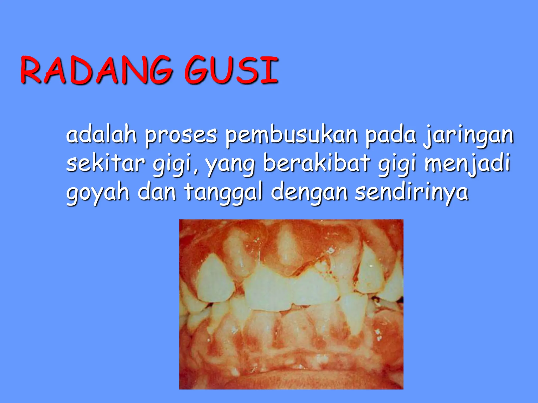 Kesehatan gigi dan mulut pada anak - anak | PPT