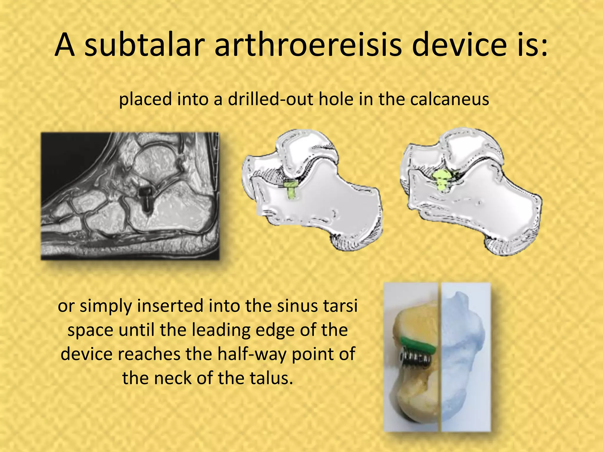 Subtalar Arthroereisis Explained | PPTX