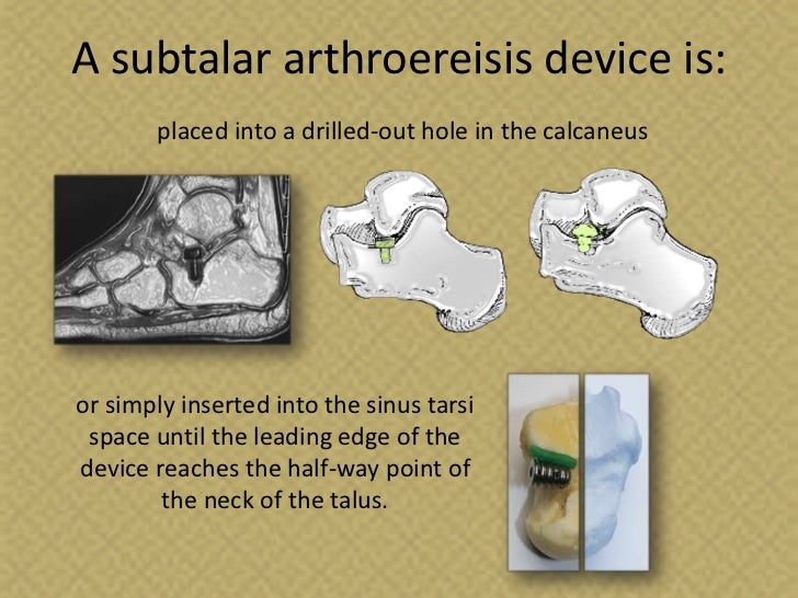 Subtalar Arthroereisis Explained