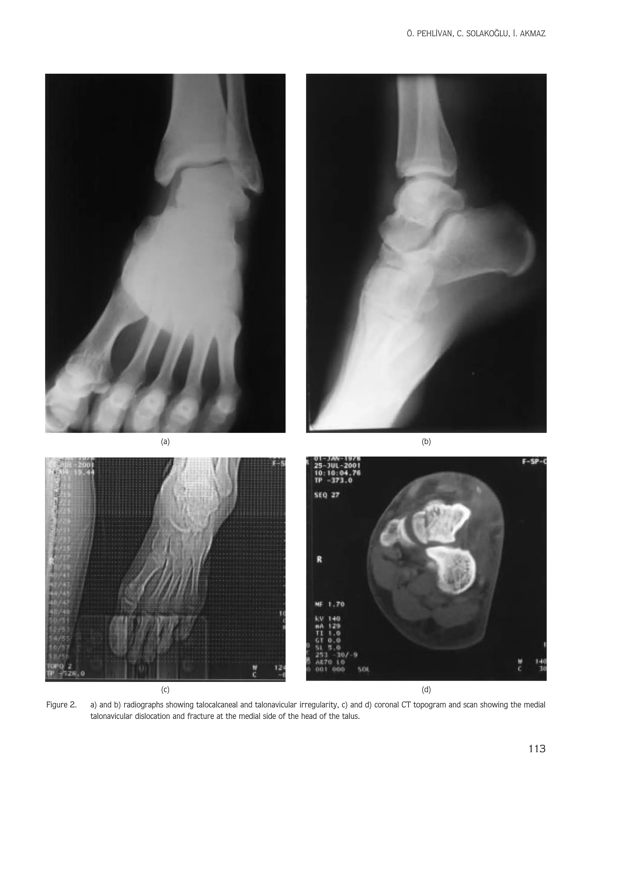 Subtalar Dislocation | PDF