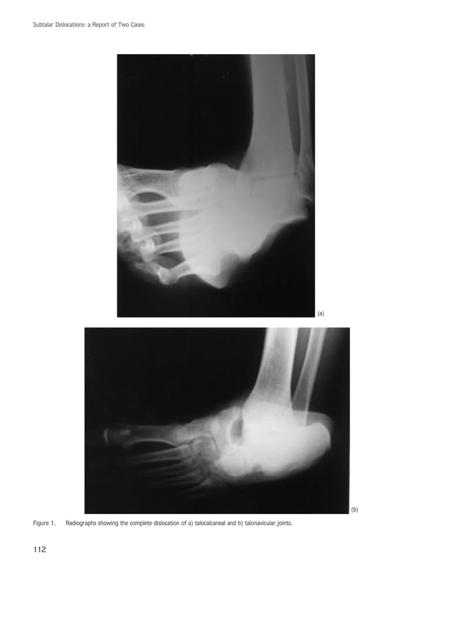 Subtalar Dislocation | PDF