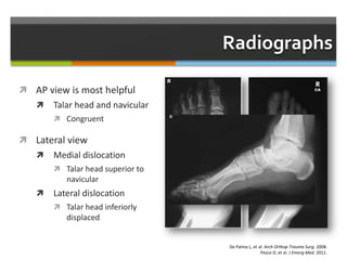 Subtalar Dislocations | PPTX