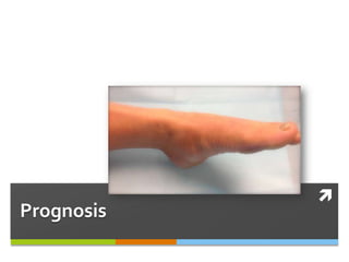 Subtalar Dislocations | PPTX