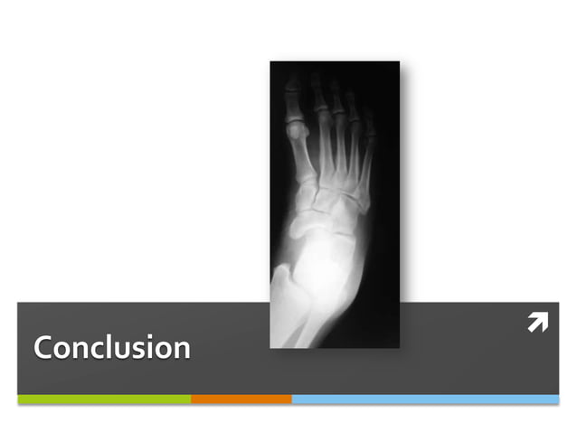 Subtalar Dislocations | PPTX