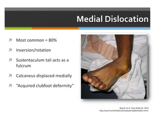 Subtalar Dislocations | PPTX