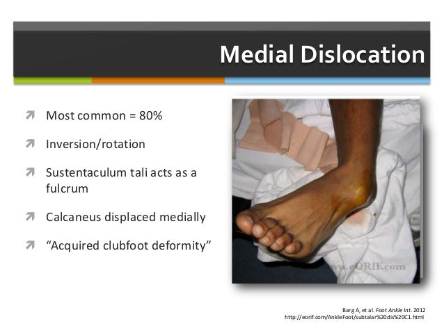 Subtalar Dislocations