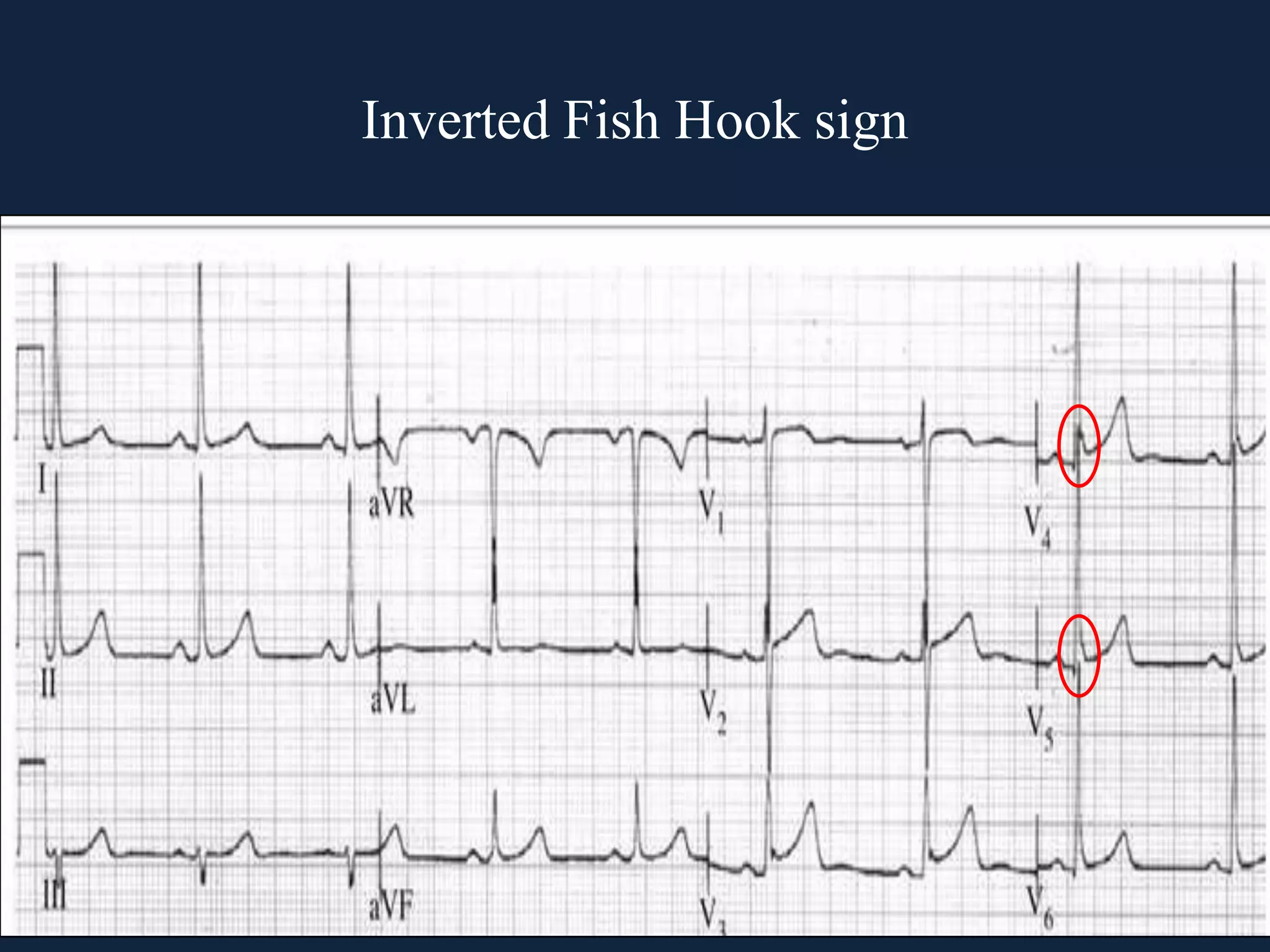 Subtle signs of myocardial ischaemia on ecg | PPTX