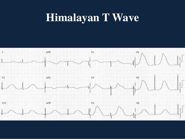 Subtle signs of myocardial ischaemia on ecg