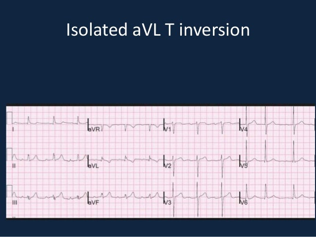 Subtle signs of myocardial ischaemia on ecg