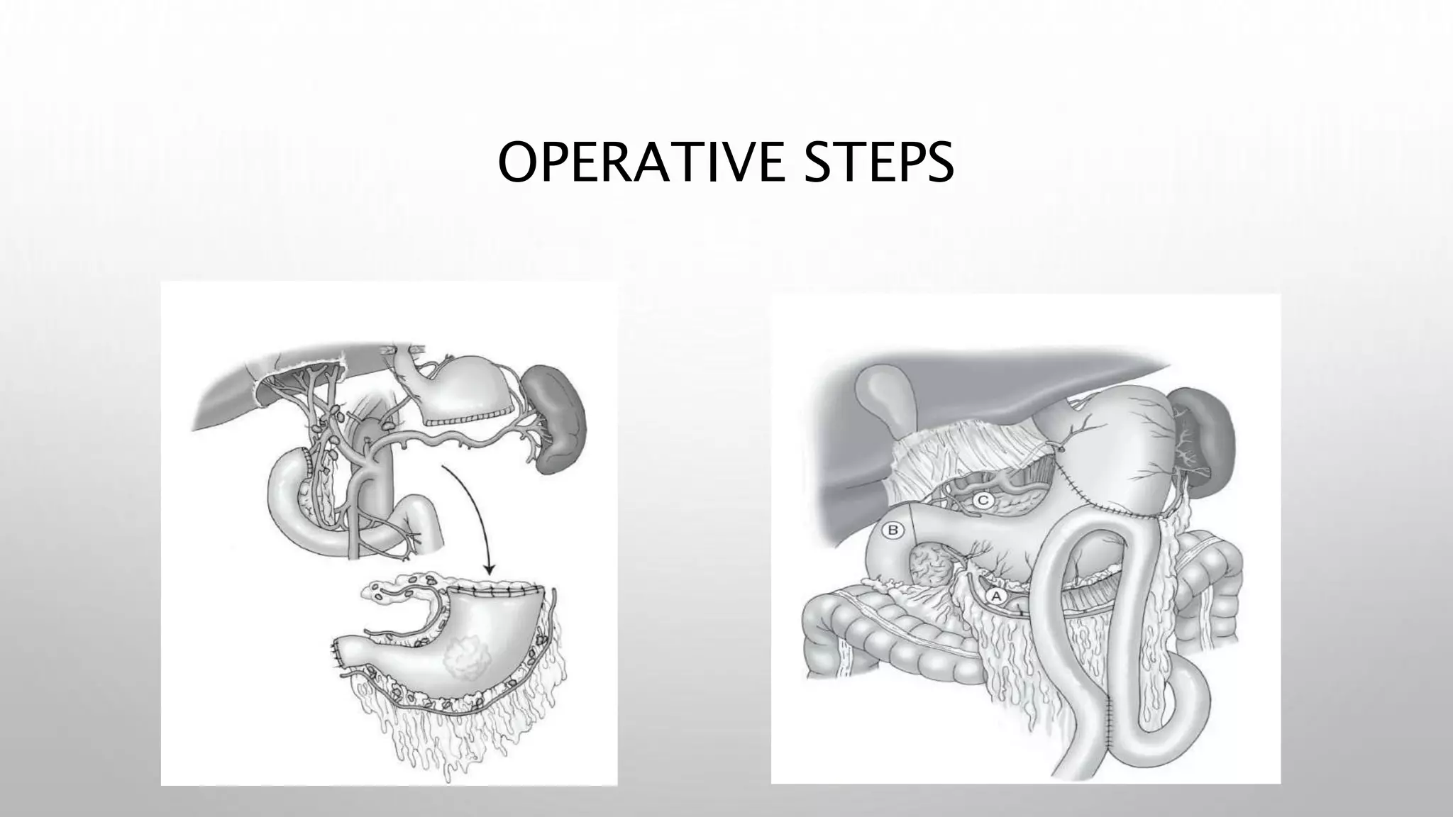 subtotal gastrectomy with gastrojejunostomy.pptx