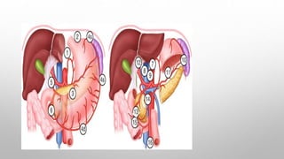 subtotal gastrectomy with gastrojejunostomy.pptx