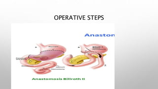 subtotal gastrectomy with gastrojejunostomy.pptx