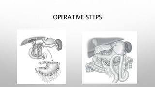 subtotal gastrectomy with gastrojejunostomy.pptx