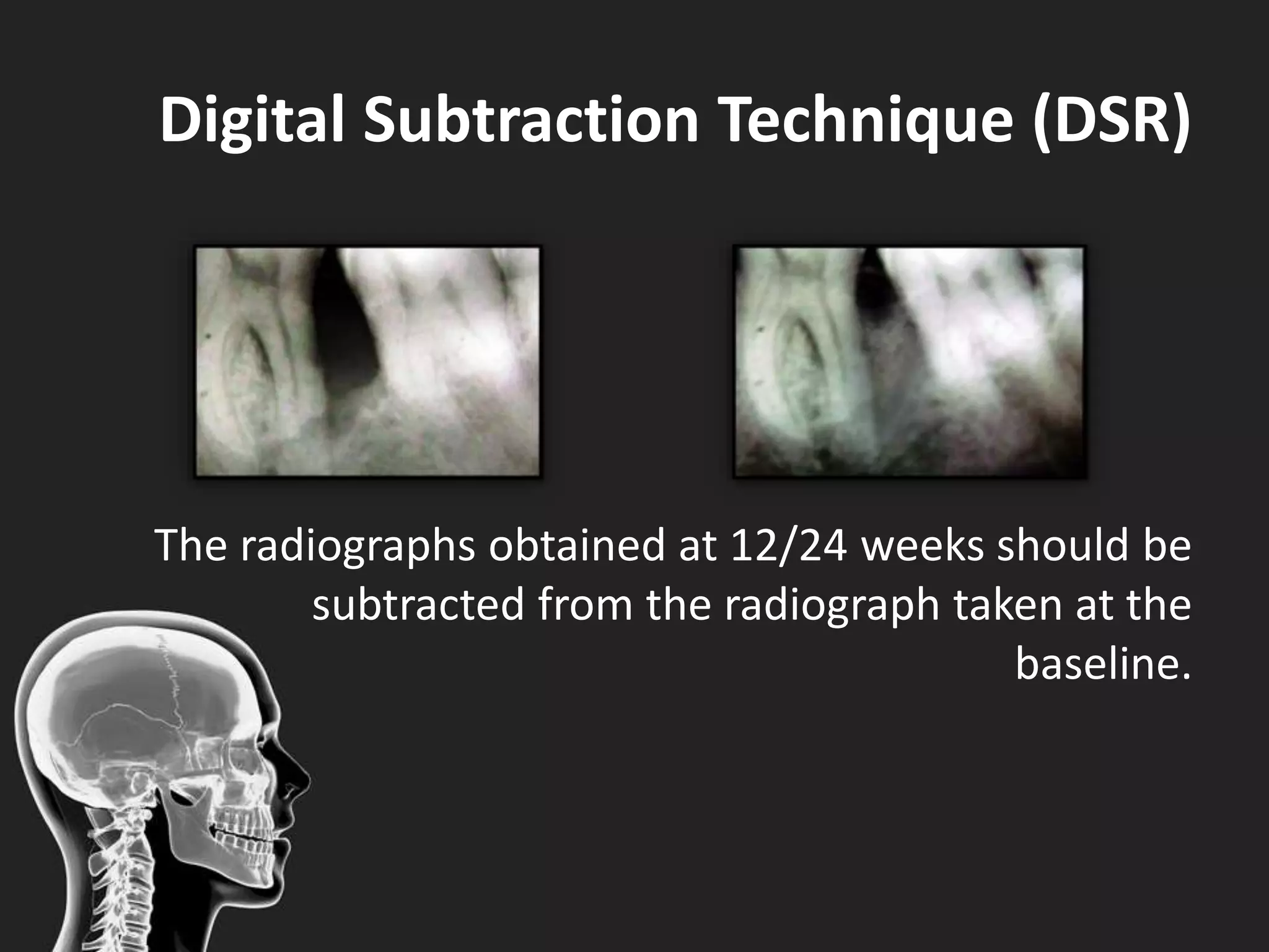Subtraction radiography and morphometric analysis in periodontics | PPTX