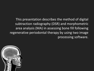 Subtraction radiography and morphometric analysis in periodontics ...