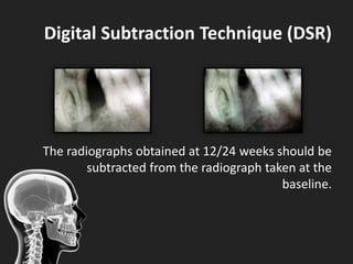 Subtraction radiography and morphometric analysis in periodontics ...