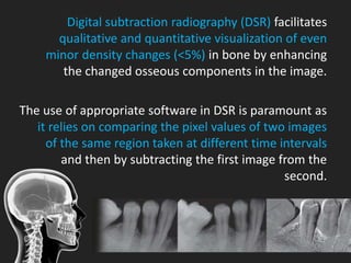 Subtraction radiography and morphometric analysis in periodontics ...