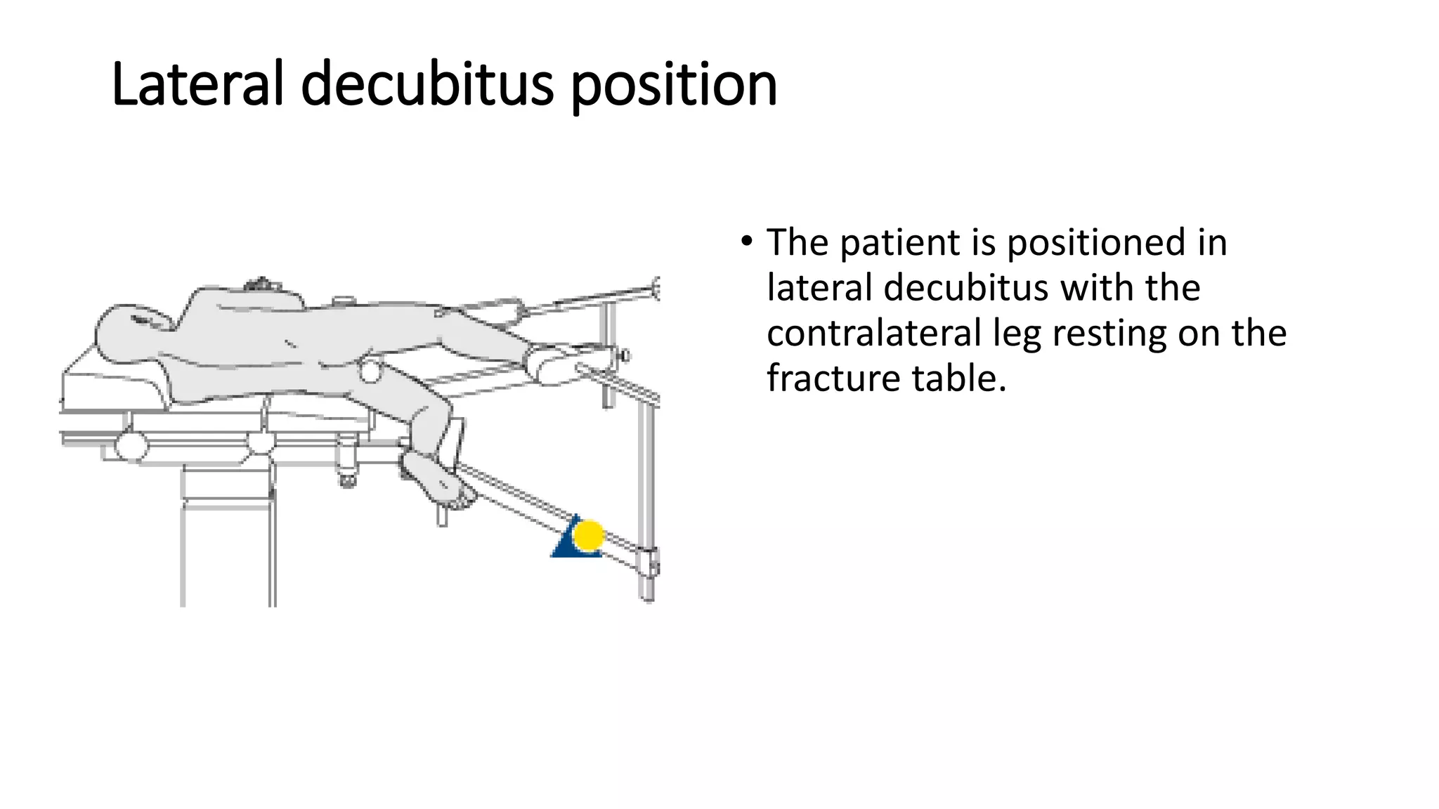 Subtrochanteric fracture | PPTX