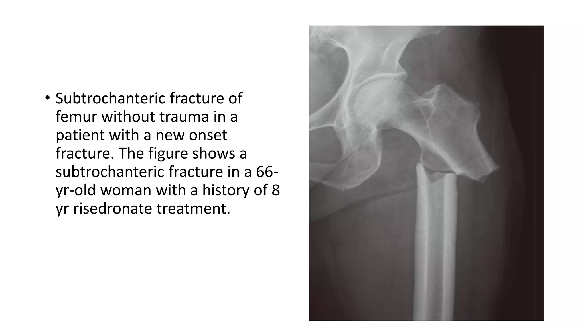Subtrochanteric fracture | PPTX