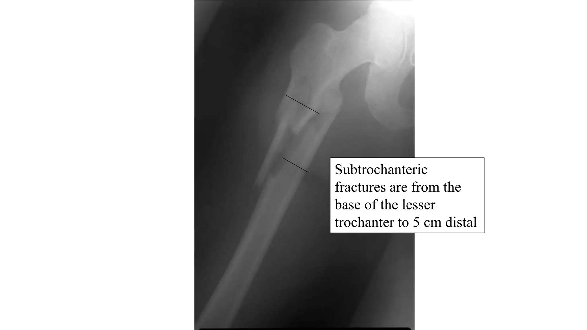 Subtrochanteric fracture | PPTX