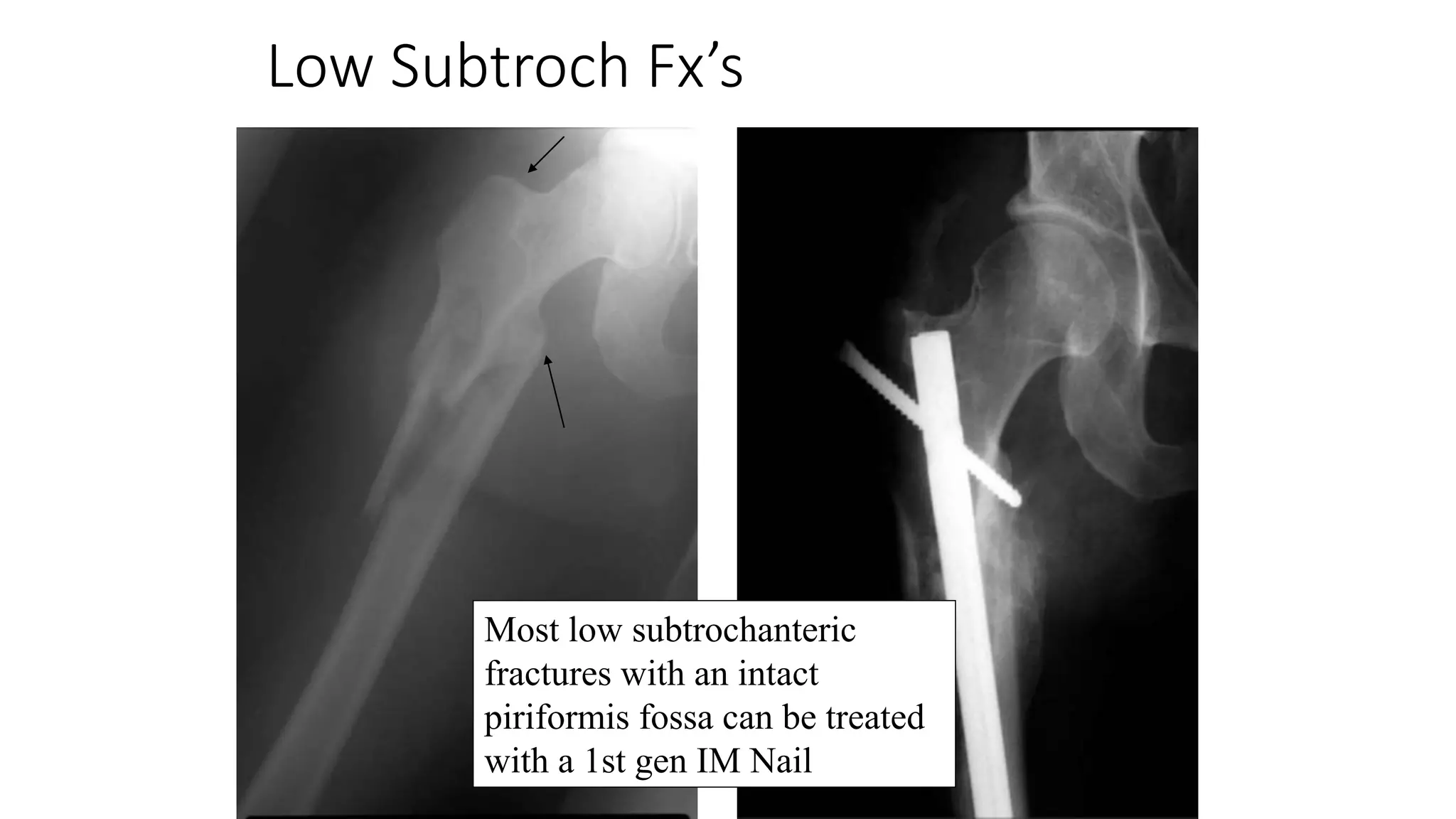 Subtrochanteric fracture | PPTX