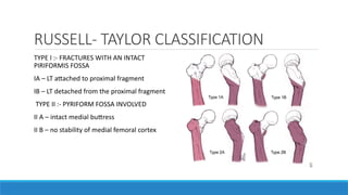 SUBTROCHANTERIC FEMUR FRACTURES.pptx..... | PPTX