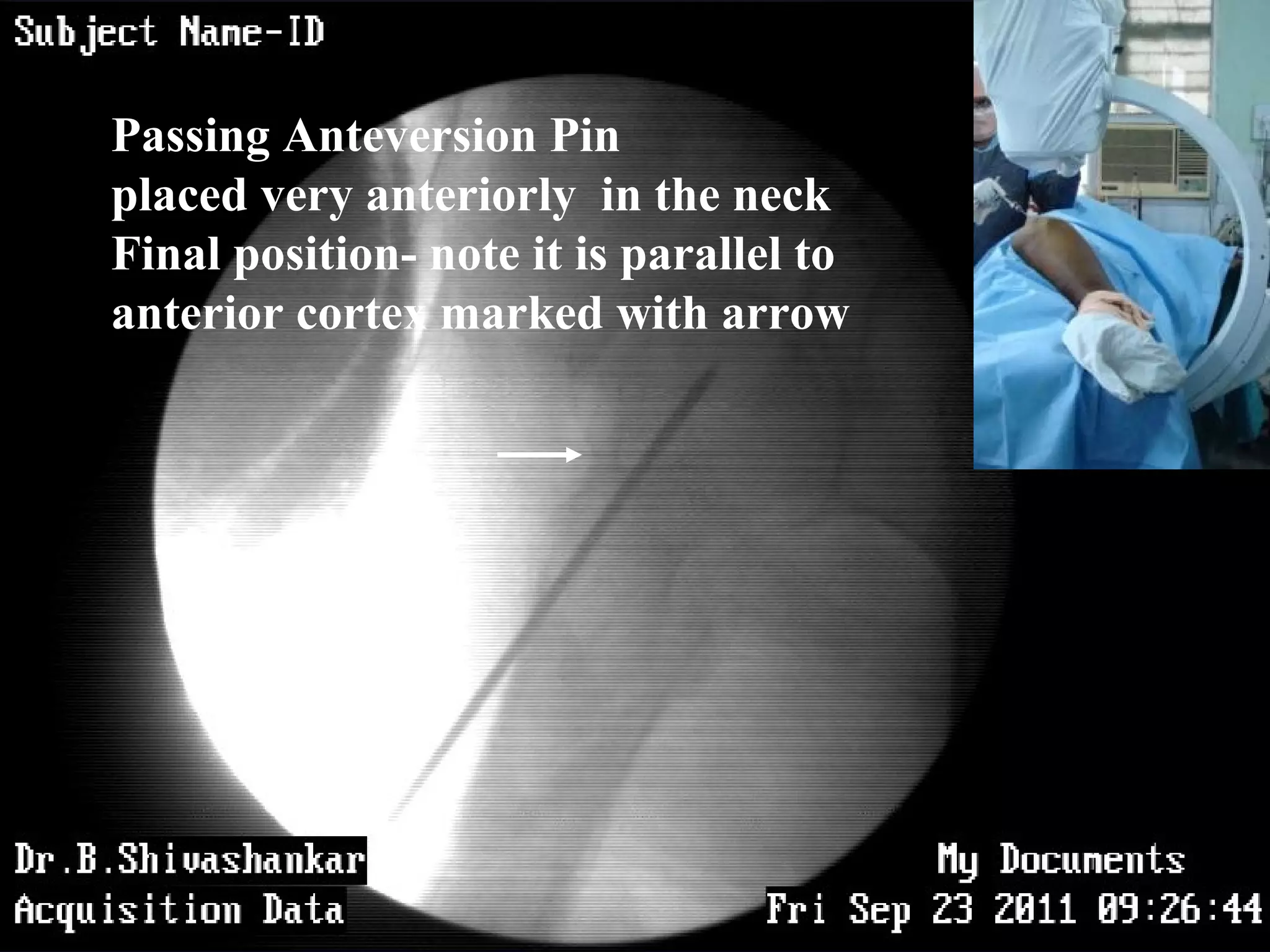 Sub trochanteric fractre nailing in lateral position | PPT