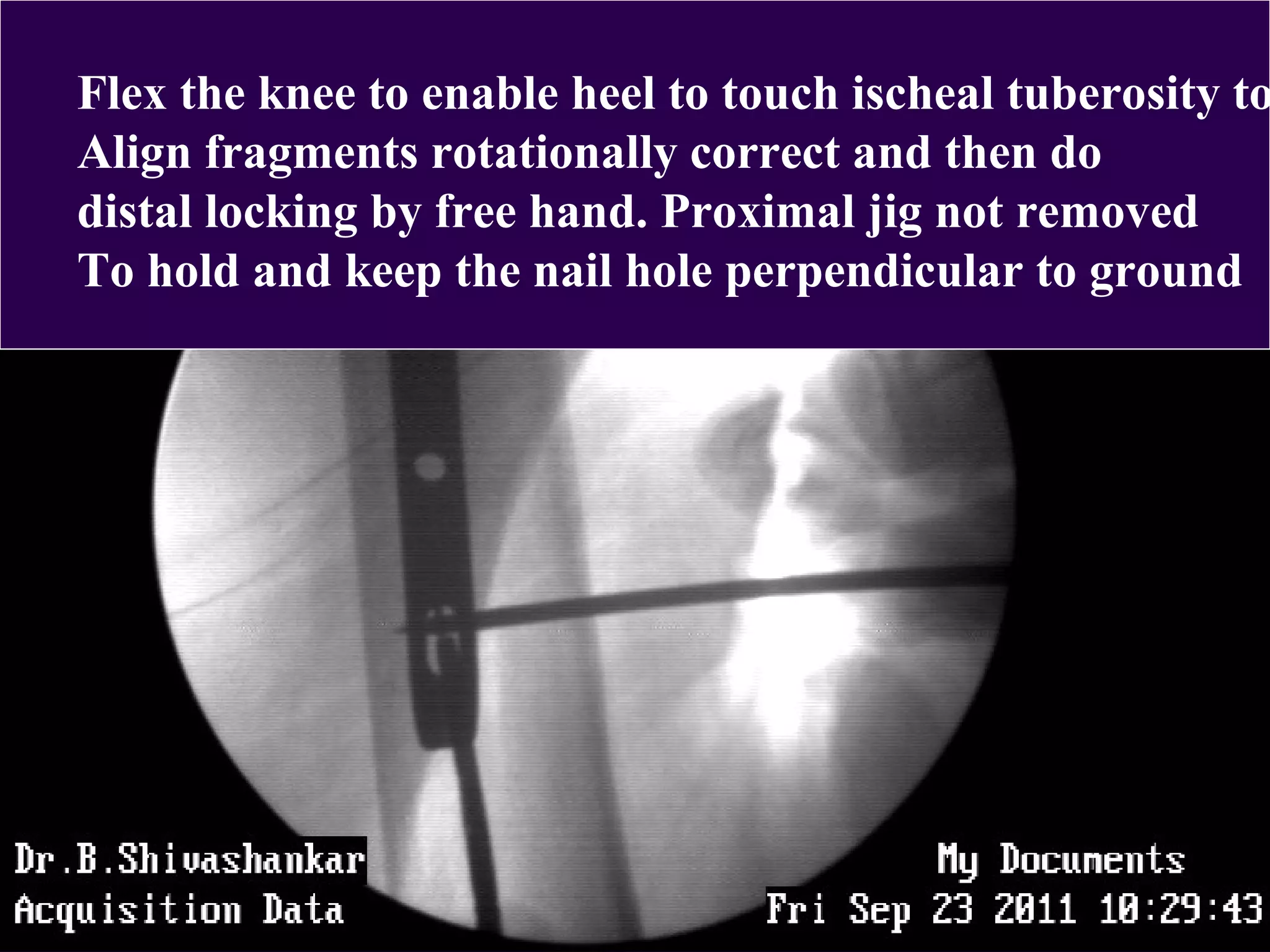 Sub trochanteric fractre nailing in lateral position | PPT