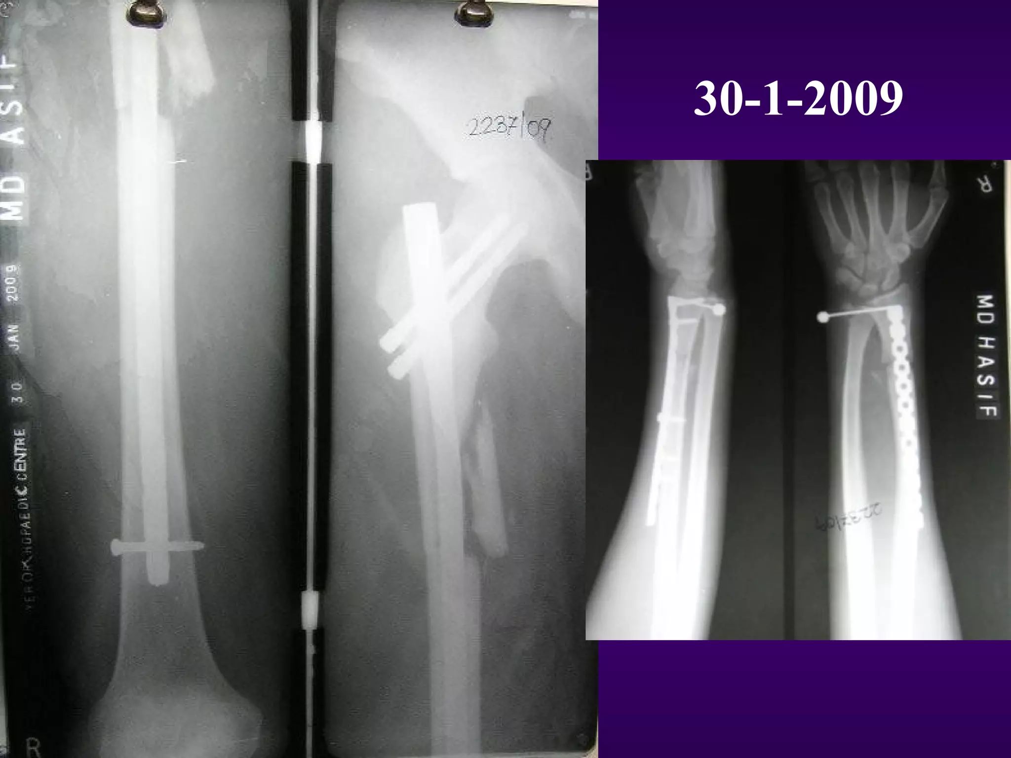 Sub trochanteric fractre nailing in lateral position | PPT
