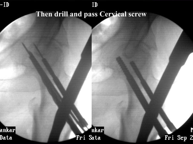 Sub trochanteric fractre nailing in lateral position | PPT | Death ...