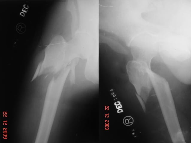 Sub trochanteric fractre nailing in lateral position | PPT | Death ...