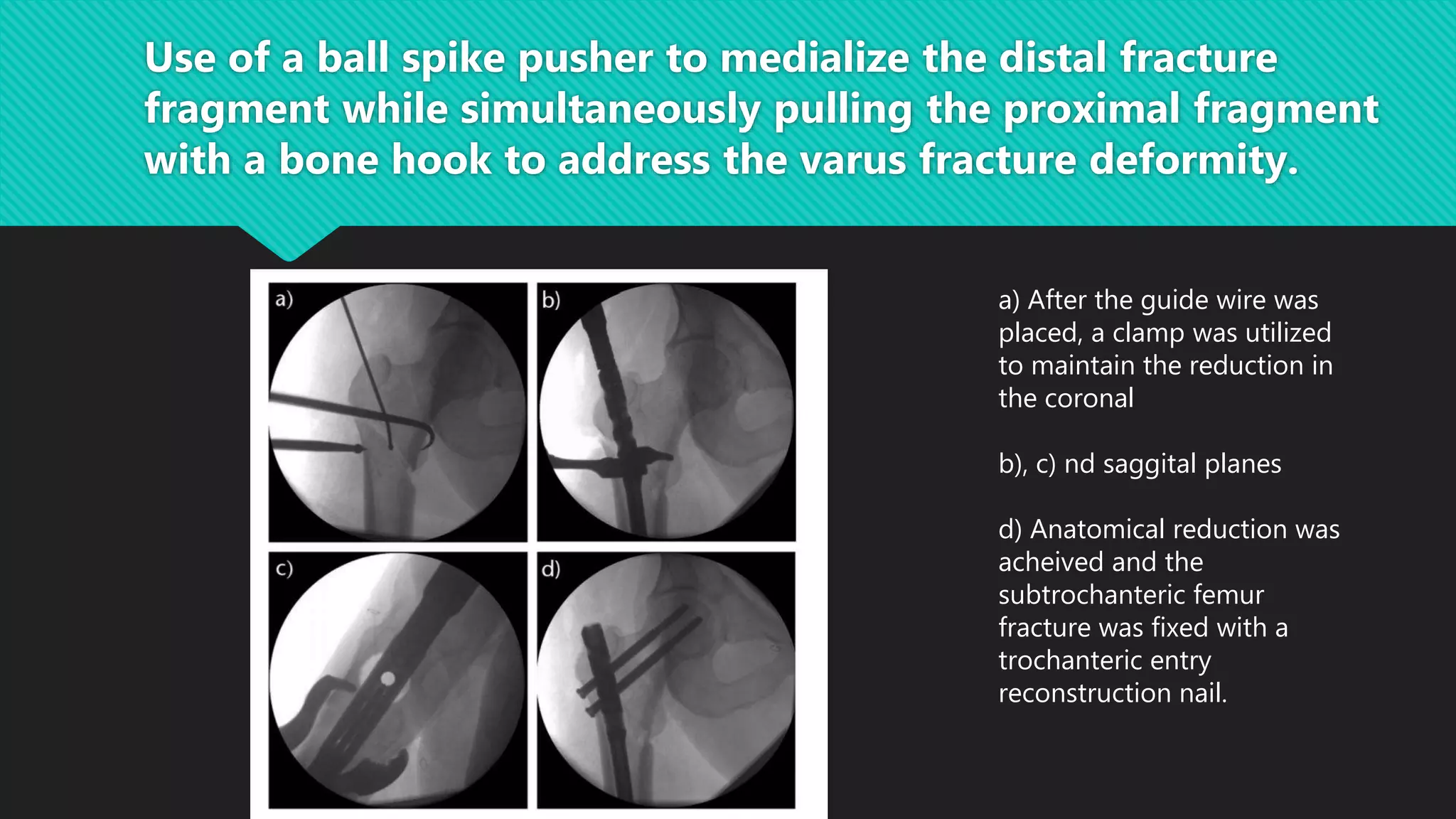 Sub trochanteric fracture journal | PPTX