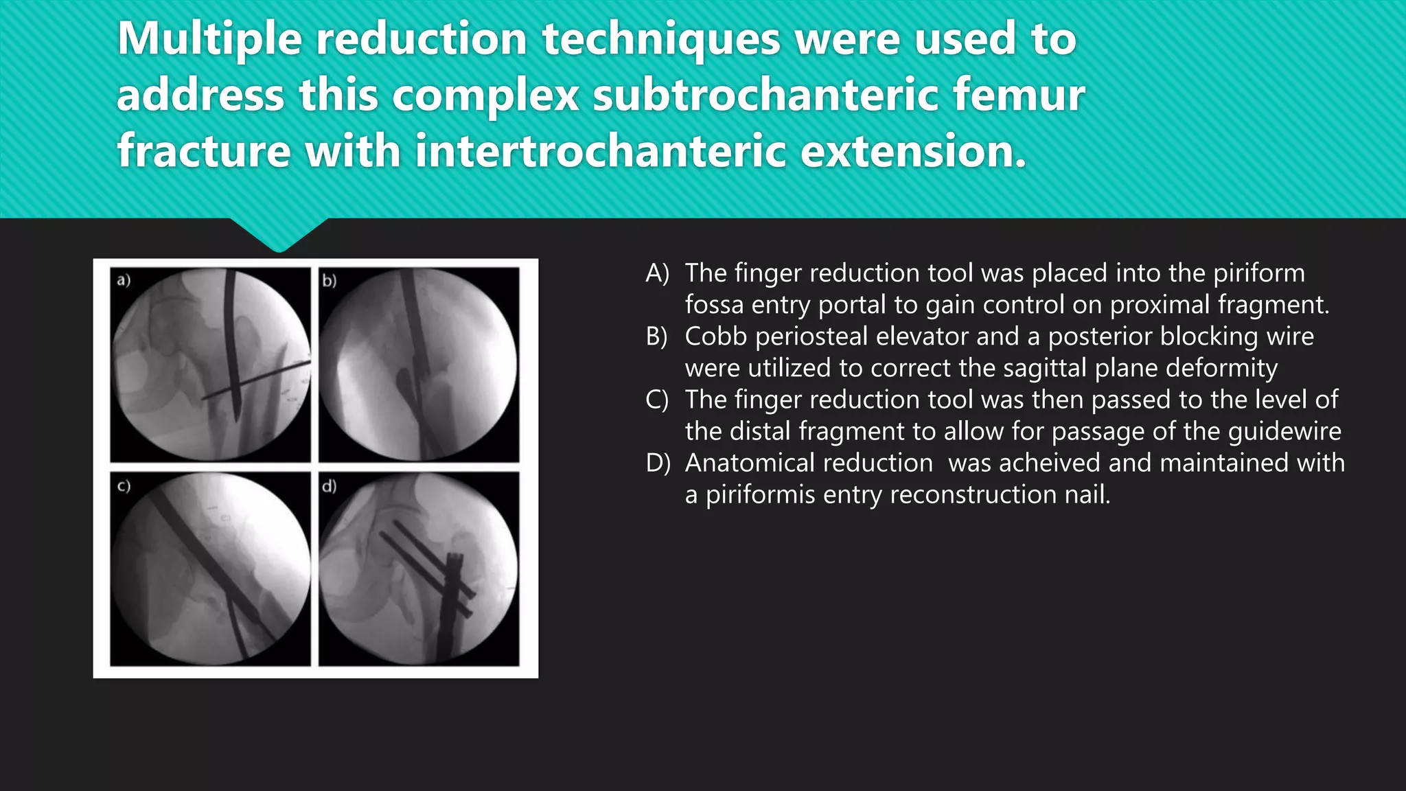 Sub trochanteric fracture journal | PPTX