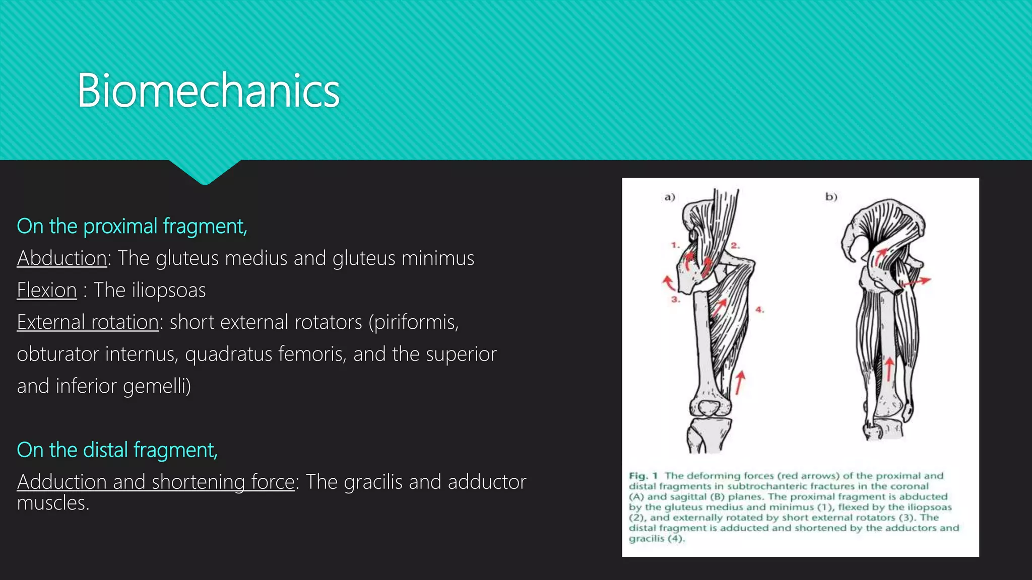 Sub trochanteric fracture journal | PPTX