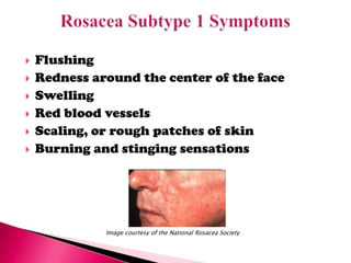 Subtypes of Rosacea and Their Symptoms | PPTX | Skin and Dermatology ...