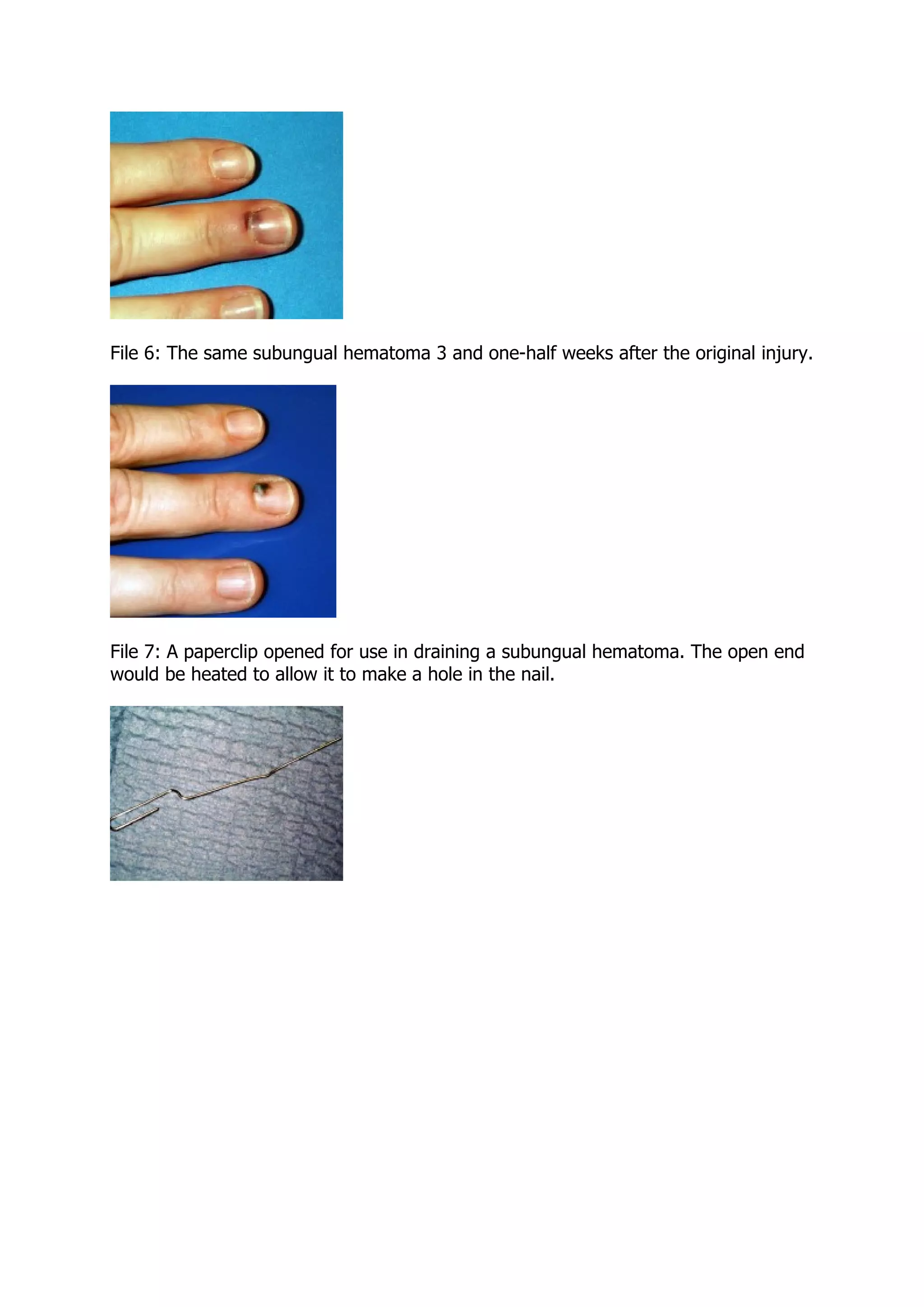 Subungual Hematoma | DOC | Death, Injury, or Military Conflict ...