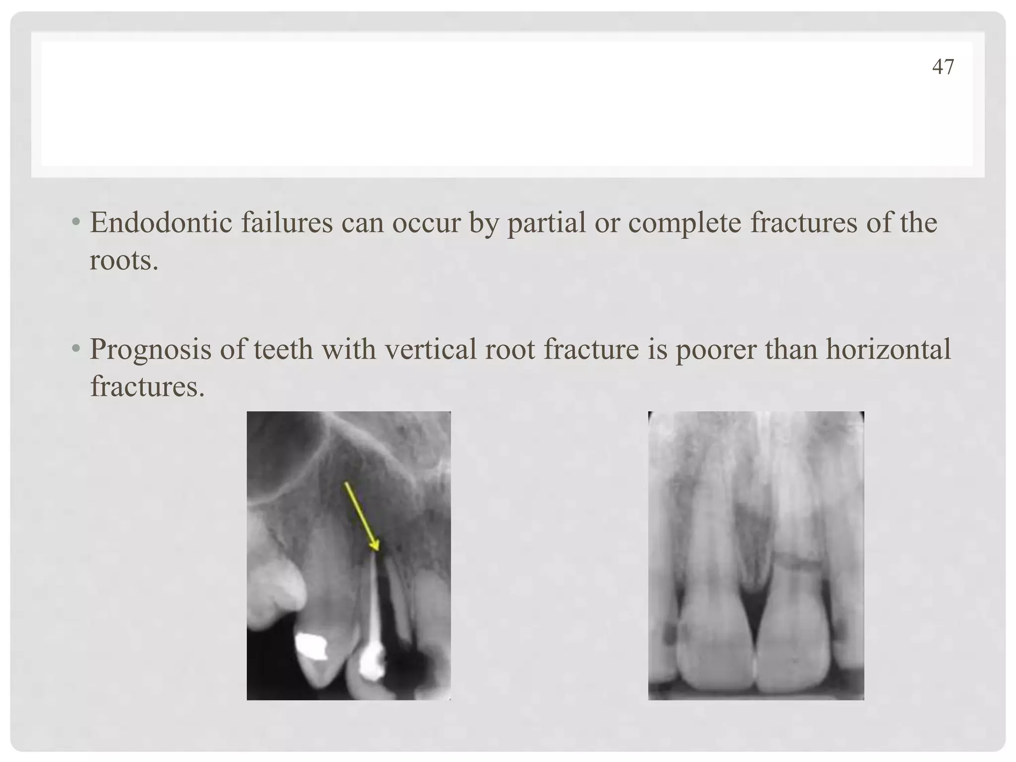 Success and failures in Endodontics | PPTX