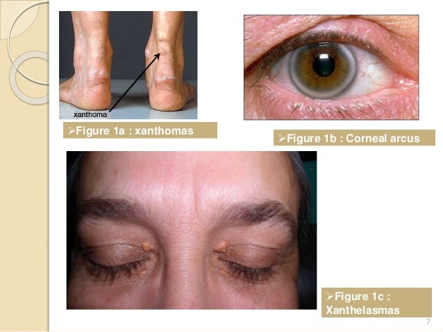 Xanthomatose Cerebrotendineuse
