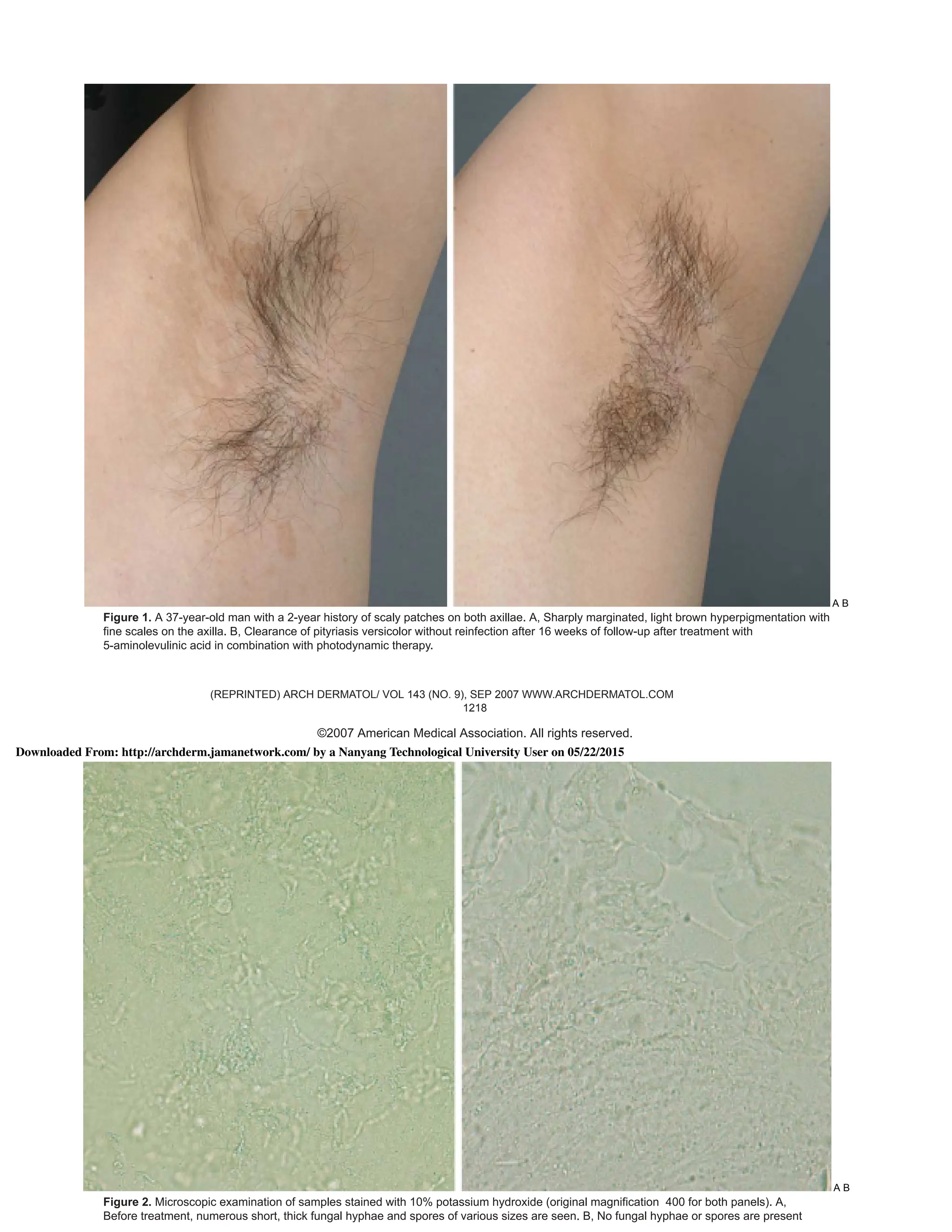 Successful Treatment of Pityriasis Versicolor.pdf